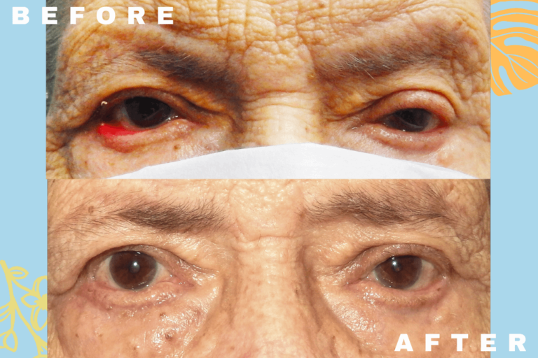 Ectropion Repair Honolulu | Eyelid Surgery Honolulu | Oculoplastics Center